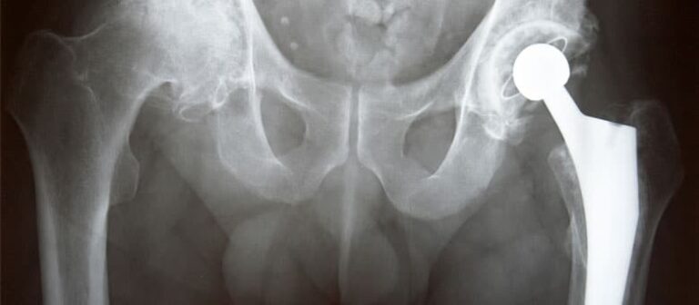 Hip Replacement Recall in Michigan | Hip Replacement Attorney